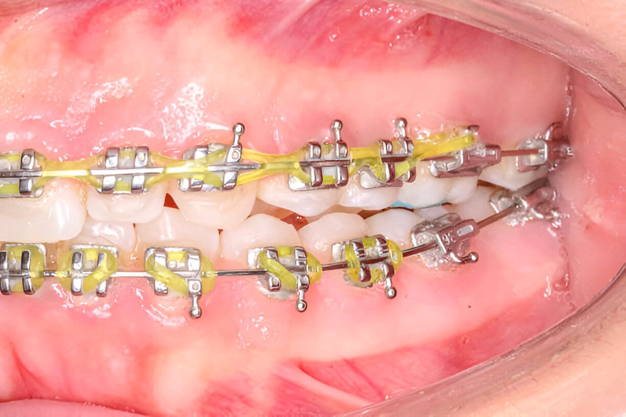 Boosting Orthodontic Treatment with Temporary Anchorage Devices ...